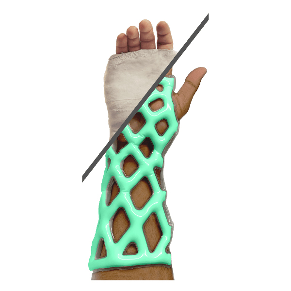 Cast 21 – Innovative casting and bracing - Medpick